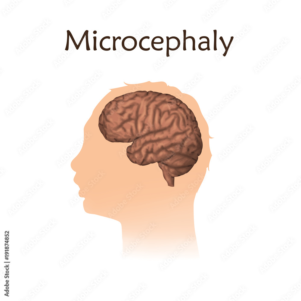 Microcephaly. White background. Silhouette of child head, brain. Stock ...