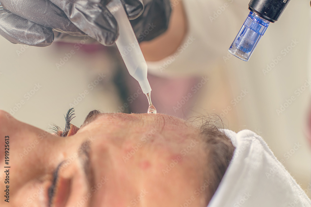 Needle mesotherapy treatment on a woman face. Stock Photo | Adobe Stock