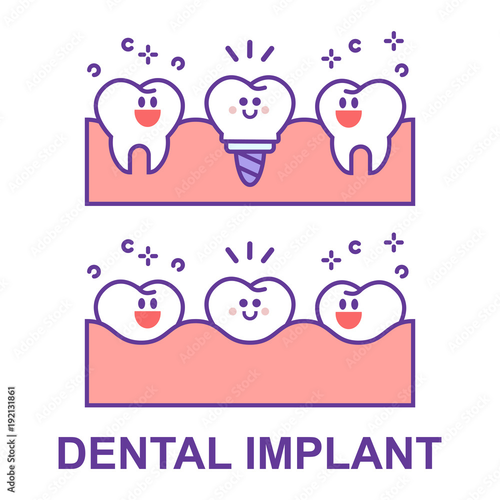 Cartoon dental implant and teeth. Smiling teeth and dental implant ...