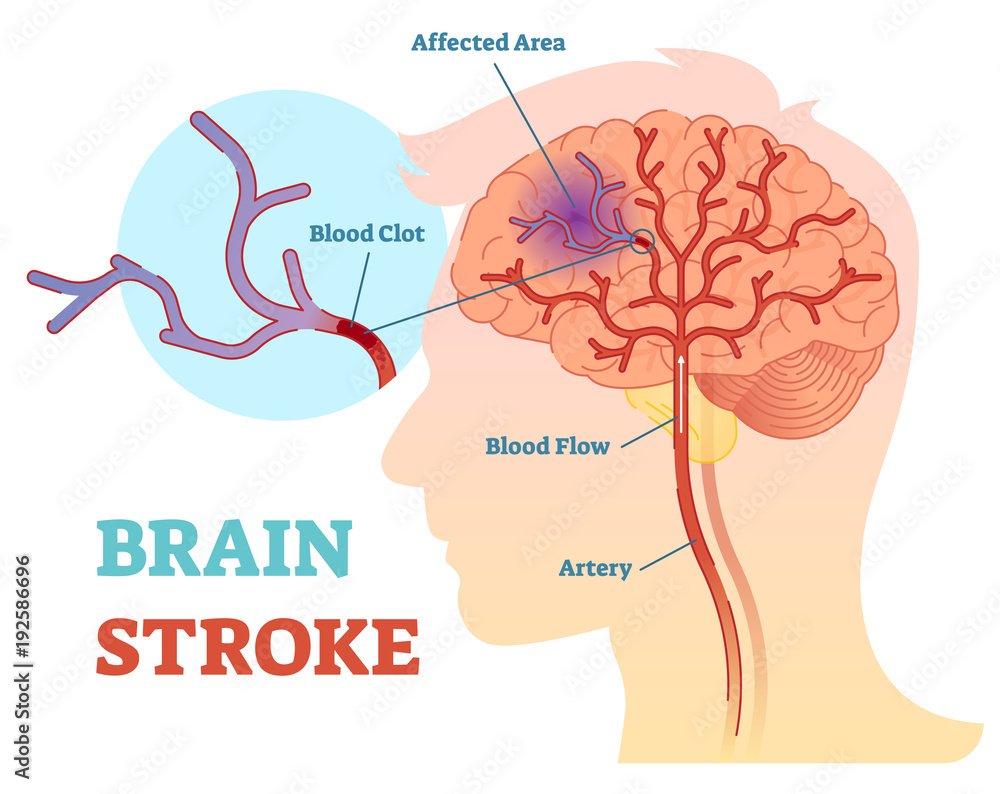 Brain Stroke anatomical vector illustration diagram, scheme Stock ...