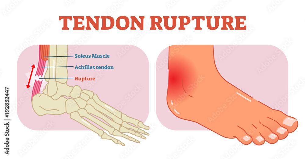Tendon rupture anatomical example, vector illustration diagram ...