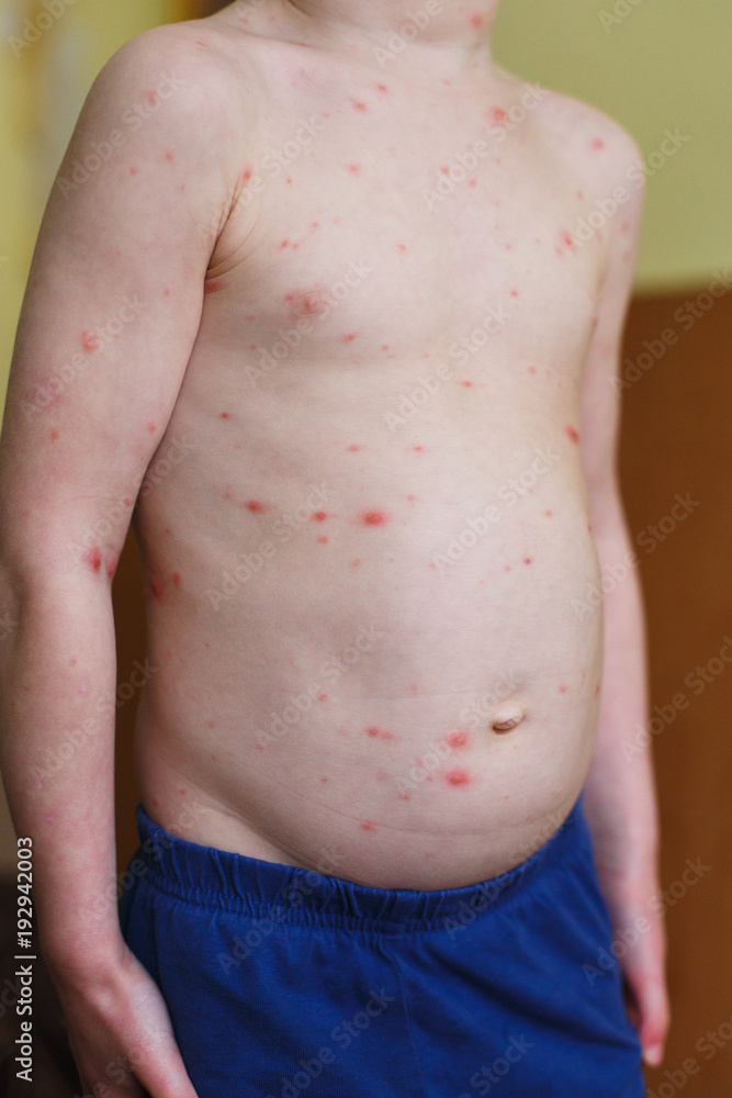 Baby with chicken pox rash. Varicella virus or Chickenpox bubble rash ...