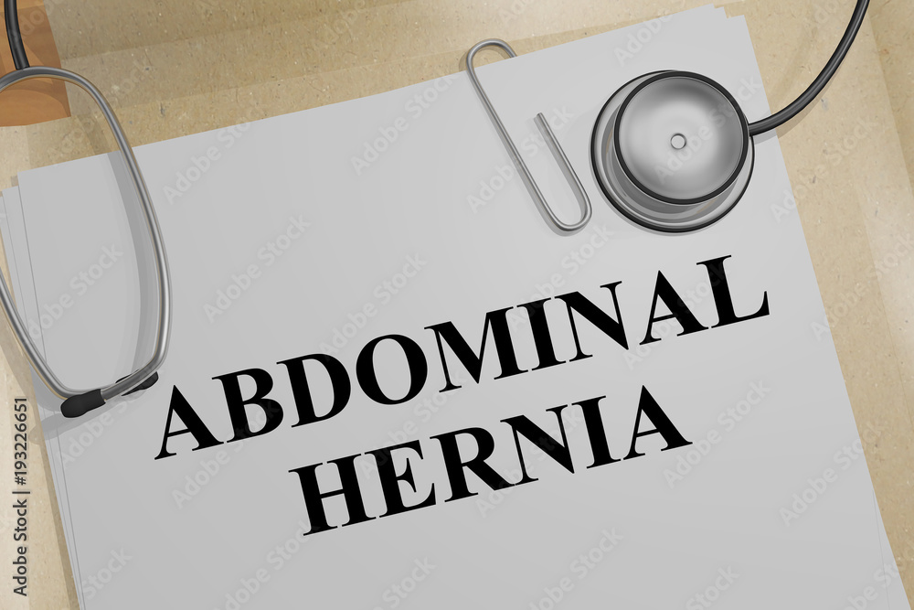 ABDOMINAL HERNIA concept Stock Illustration | Adobe Stock