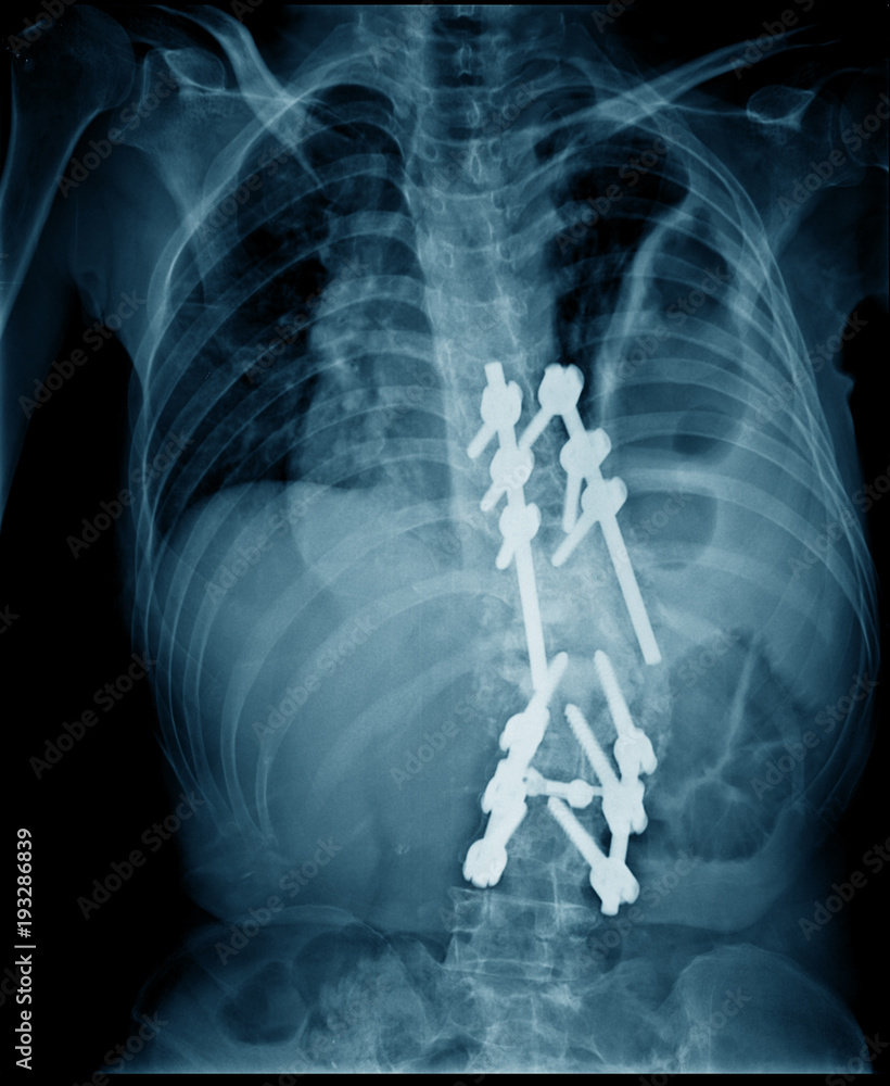 fixation of thoracic-lubar spine, x-ray image show internal fixation ...