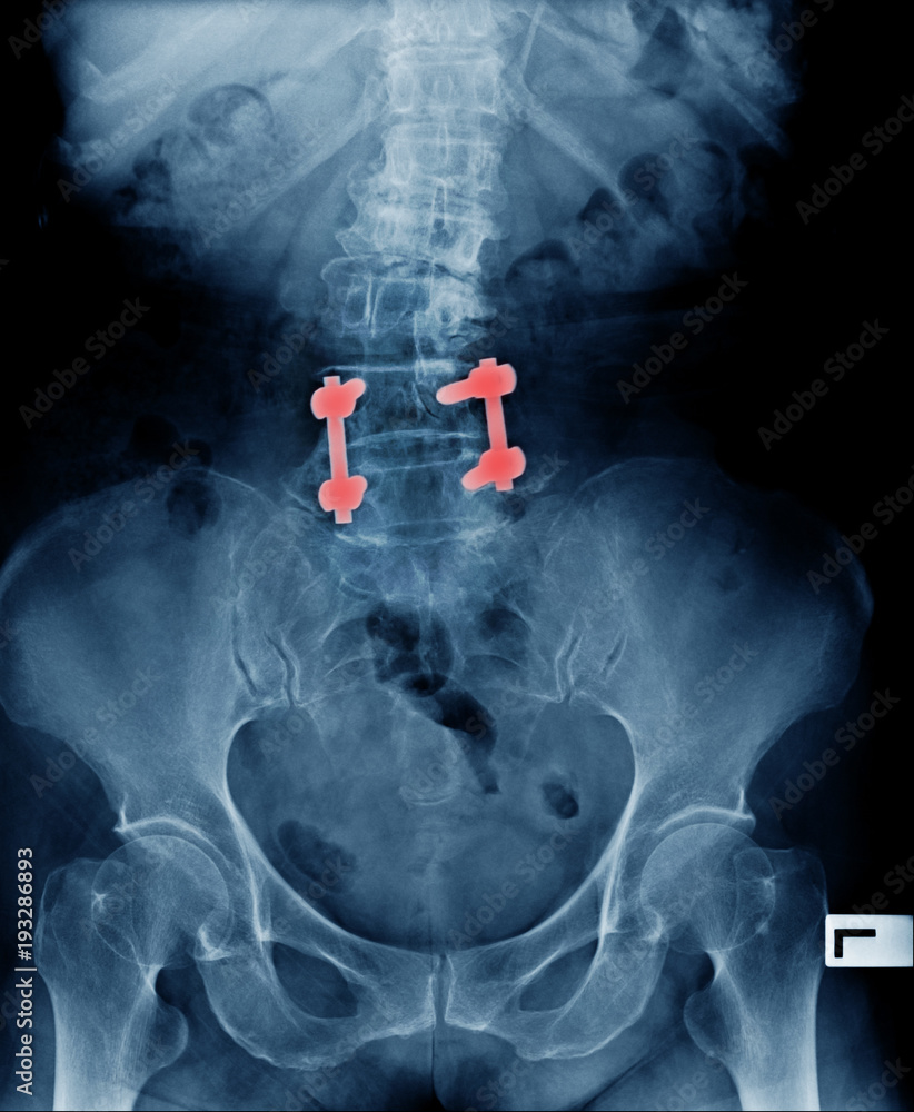 fixation of L4-5 of lumbar body, x-ray image post operation of ...