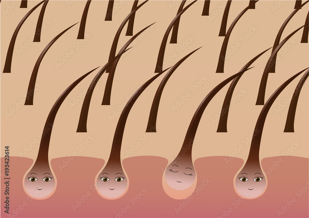 Cartoon hair follicles on the scalp suffer from loss Stock Vector ...