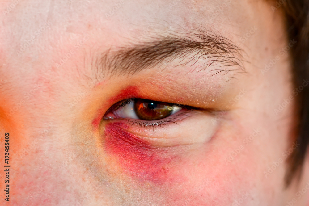 Eye injury, male with black eye isolated on white. man after accident ...