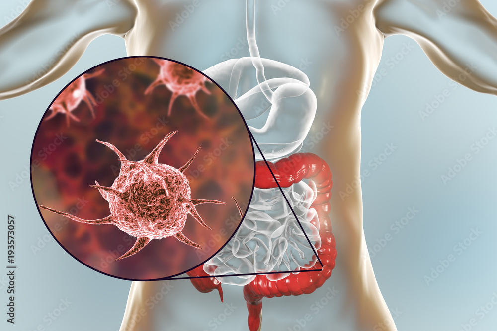 Parasitic infection of intestine, 3D illustration showing close-up view ...