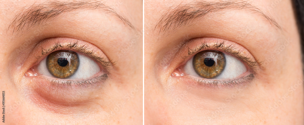 Puffy eye before and after beauty treatment Stock Photo | Adobe Stock