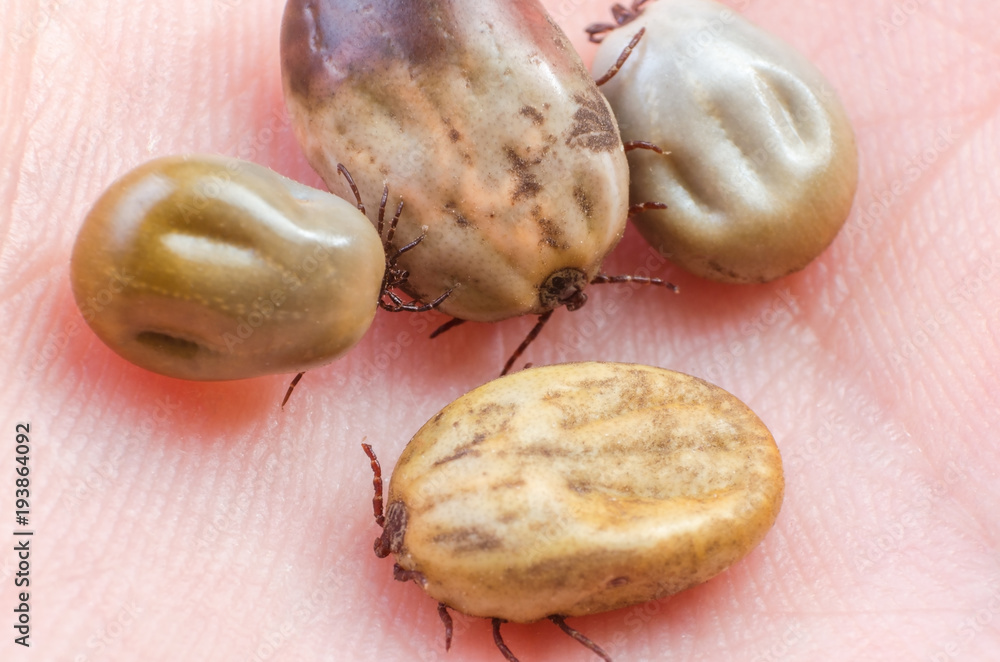 Tick filled with blood sitting on human skin Stock Photo | Adobe Stock