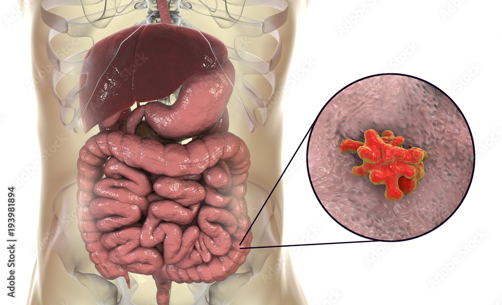 Entamoeba histolytica protozoan infection of large intestine. Parasite ...