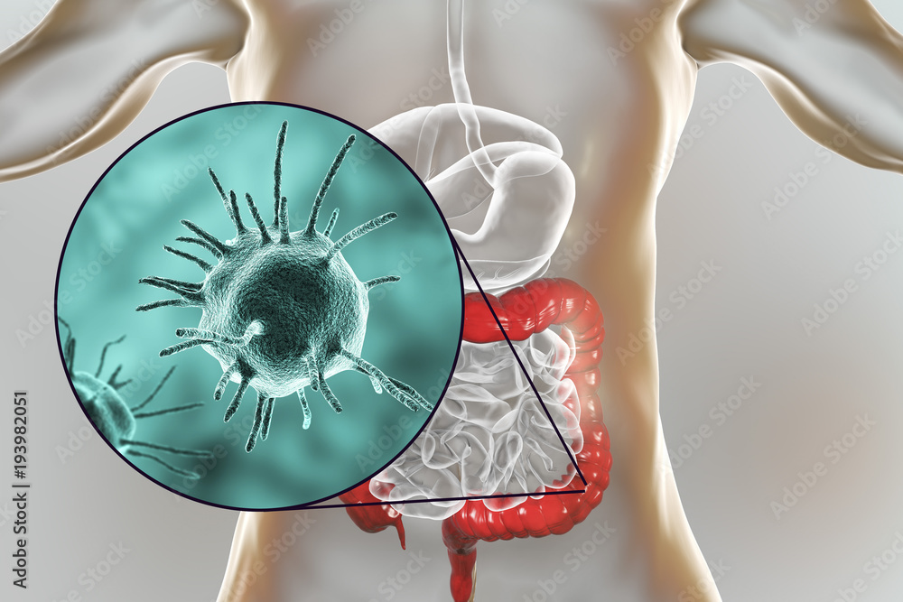 Parasitic infection of intestine, 3D illustration showing close-up view ...
