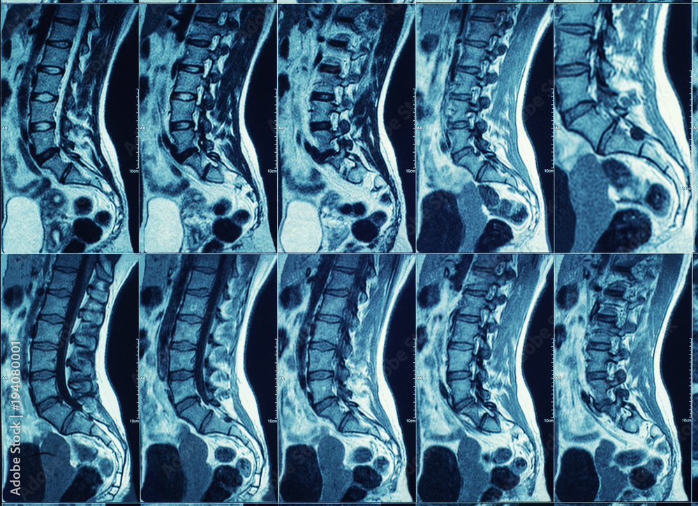 Magnetic resonance imaging (MRI) scan of spine and backbone. Stock ...