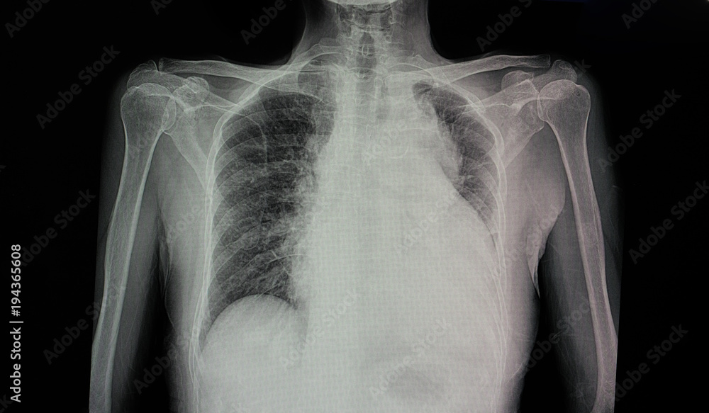 Foto de chest x-ray film of a patient with cardiomegaly do Stock ...