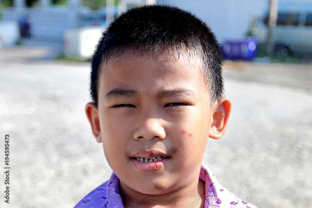asian boy smile with wound on his face and lip are crack from injury in ...