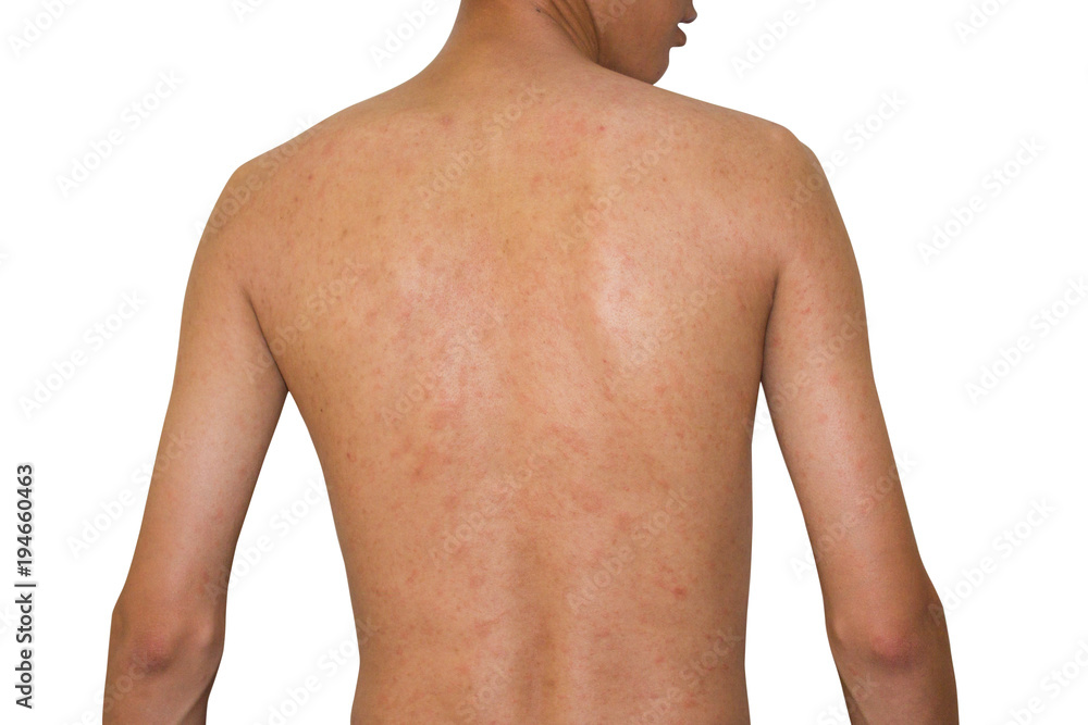 Rash On Dermatitis Problem Allergy Rash Rash On Back Skin Problem rash-on-dermatitis-problem-allergy-rash-rash-on-back-skin-problem