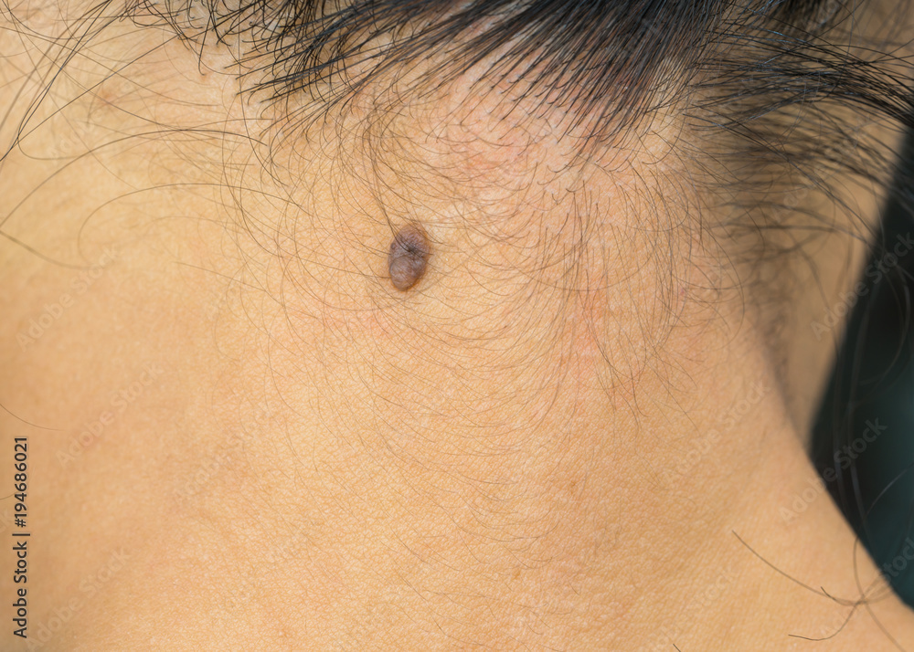 Moles On Neck
