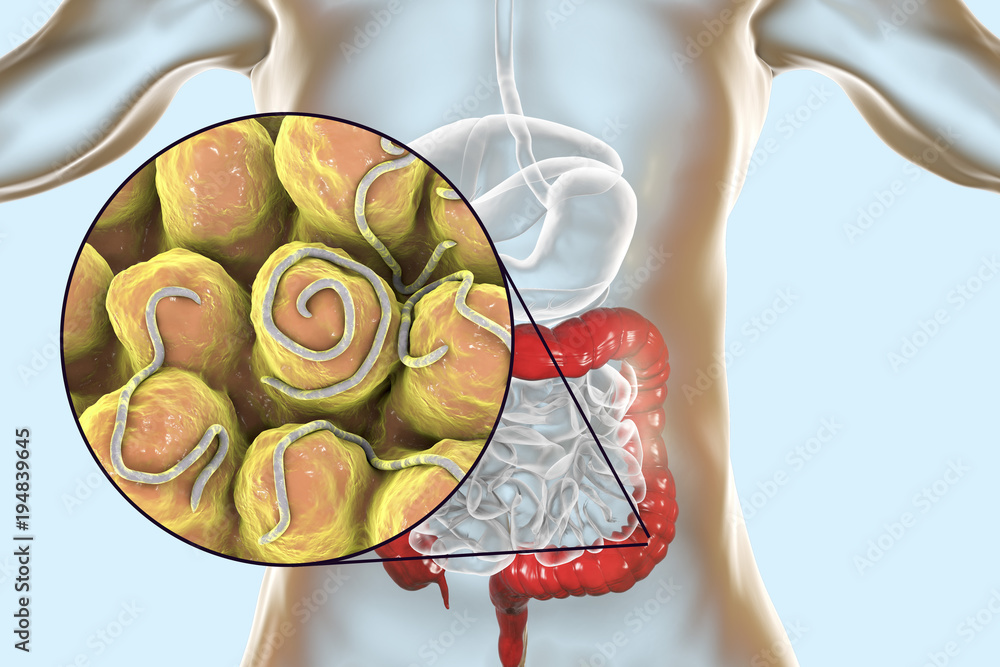 Helminths nematodes Enterobius in the gut. Threadworm which causes ...