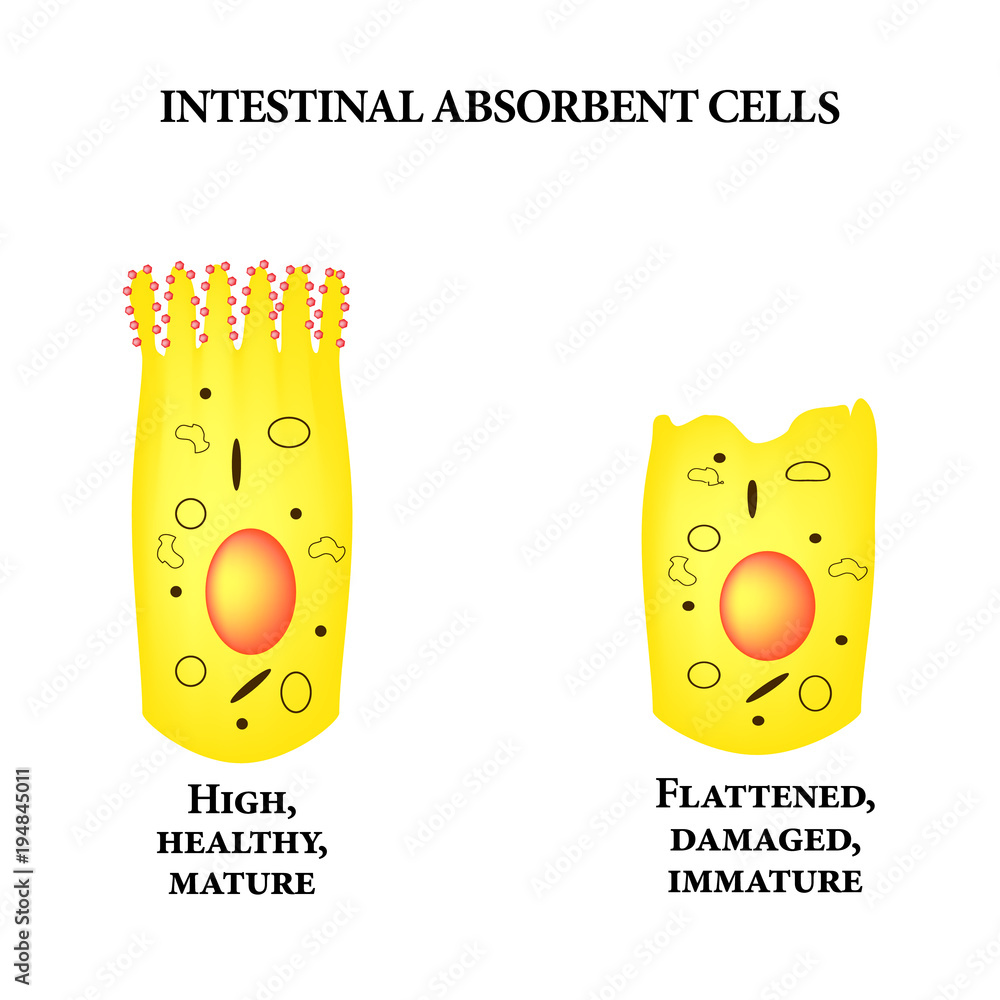 Structure of the enterocyte. Deformed, sick cell. absorptive cells ...
