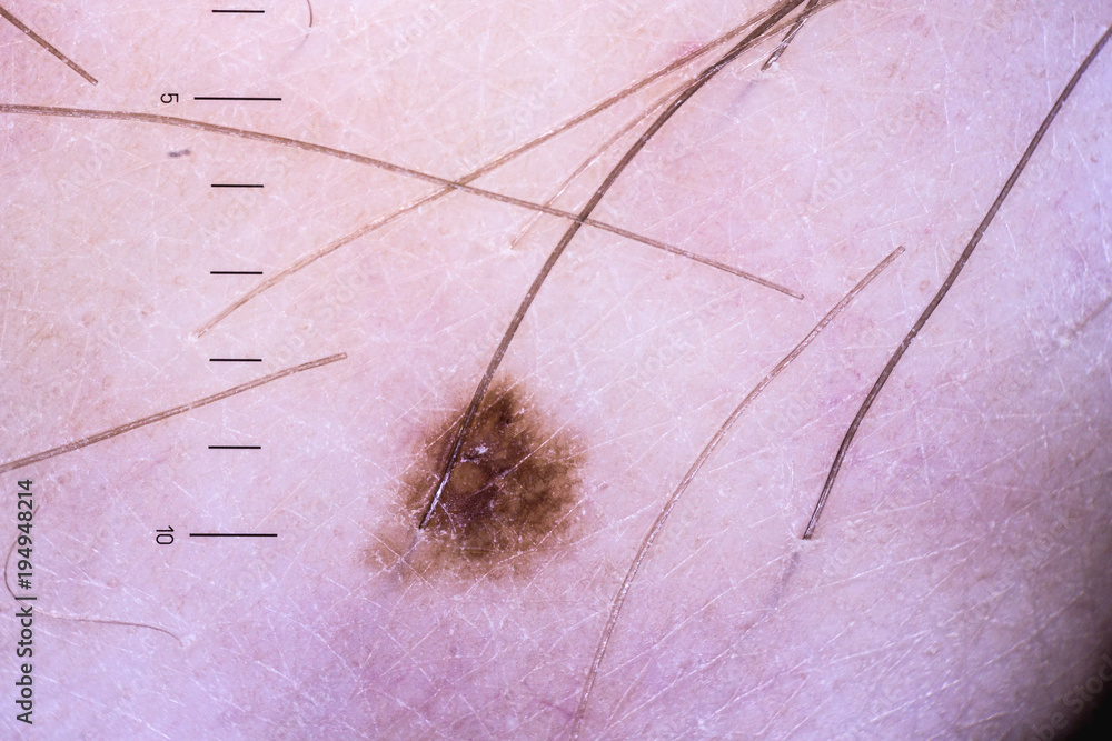 Enlarged image of the skin and moles of a man with a dermatoscope with ...
