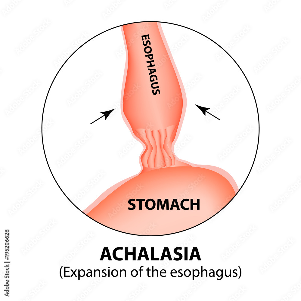 Achalasia of the esophagus. Expansion of the esophagus. Hernia ...