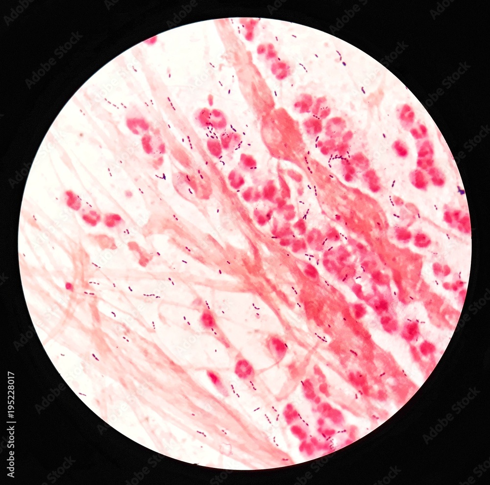 Smear of Gram's stained from sputum specimen with gram positive cocci ...