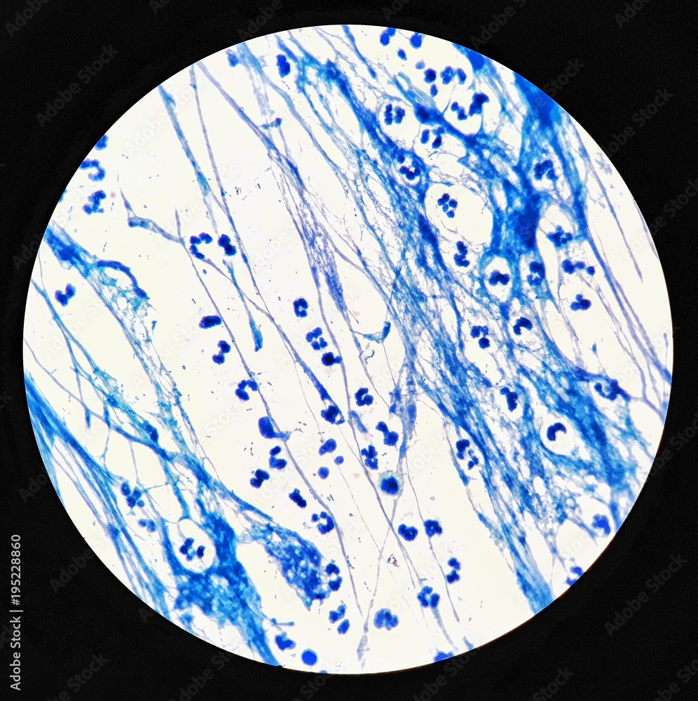 Smear of Acid-Fast bacilli (AFB) stained from sputum specimen with ...
