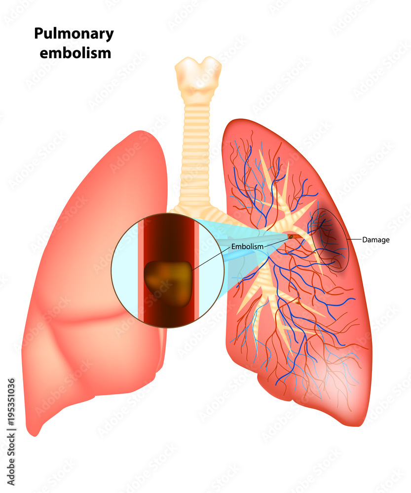 Pulmonary embolism. Vector illustration Stock Vector | Adobe Stock