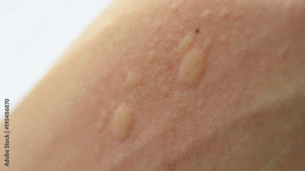 Macro image of symptoms of itchy urticaria or rash Stock Photo | Adobe ...