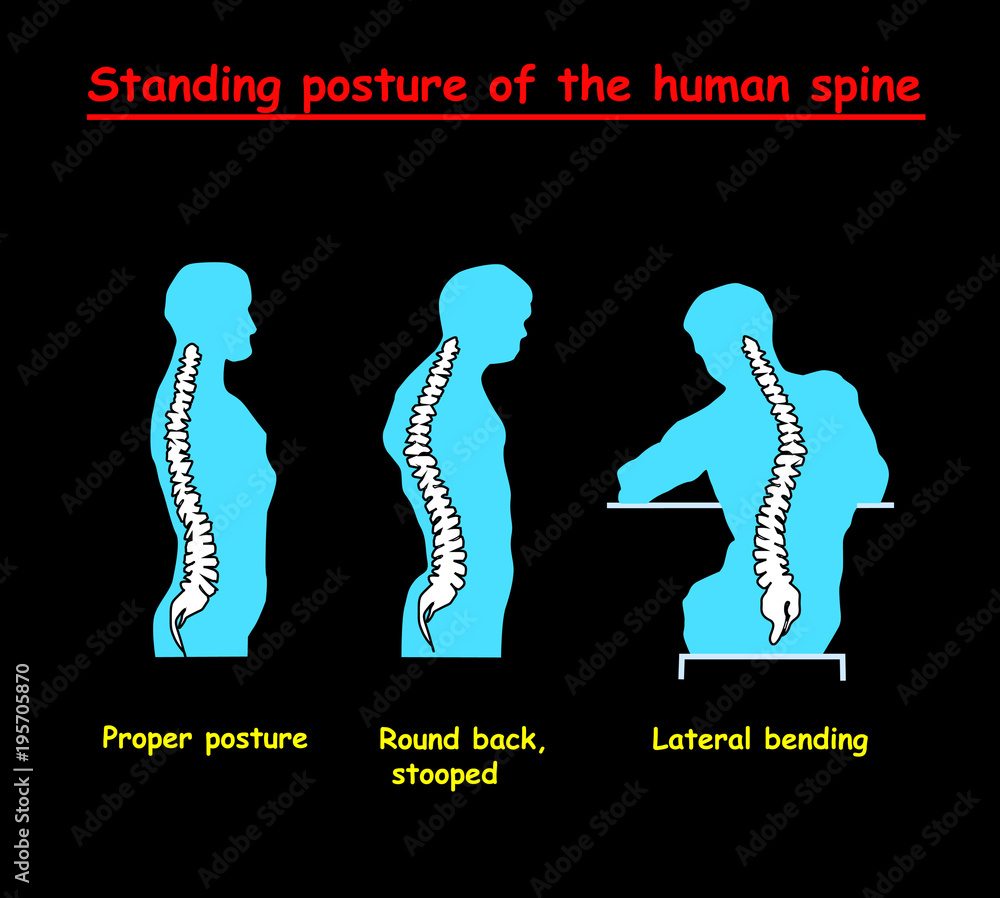 Standing posture of the blue human spine. Defects of the human spine ...