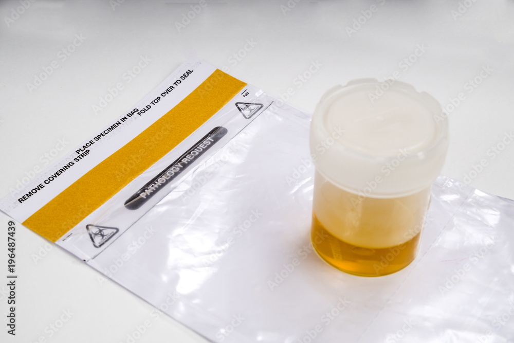 Human Urine Sample Human urine sample waiting for testing, with a ...