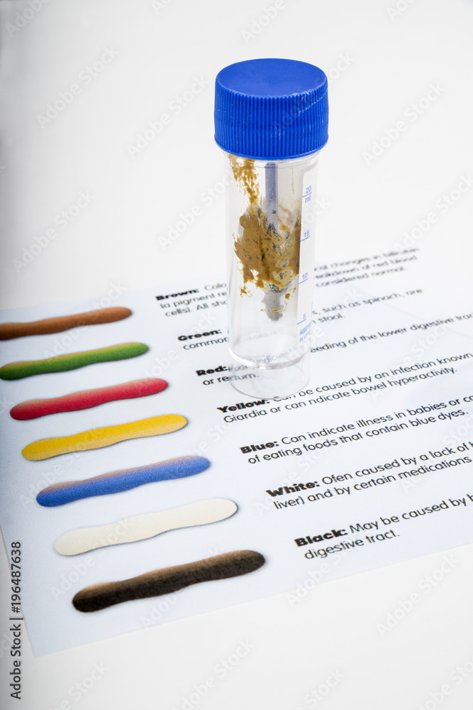 Human Stool Sample. Human stool sample waiting for testing, with a ...