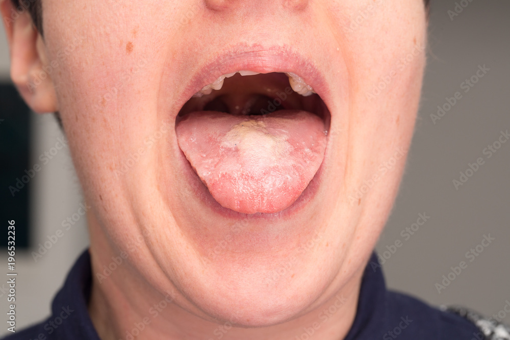 Photo & Art Print Candida albicans white infection on woman tongue ...
