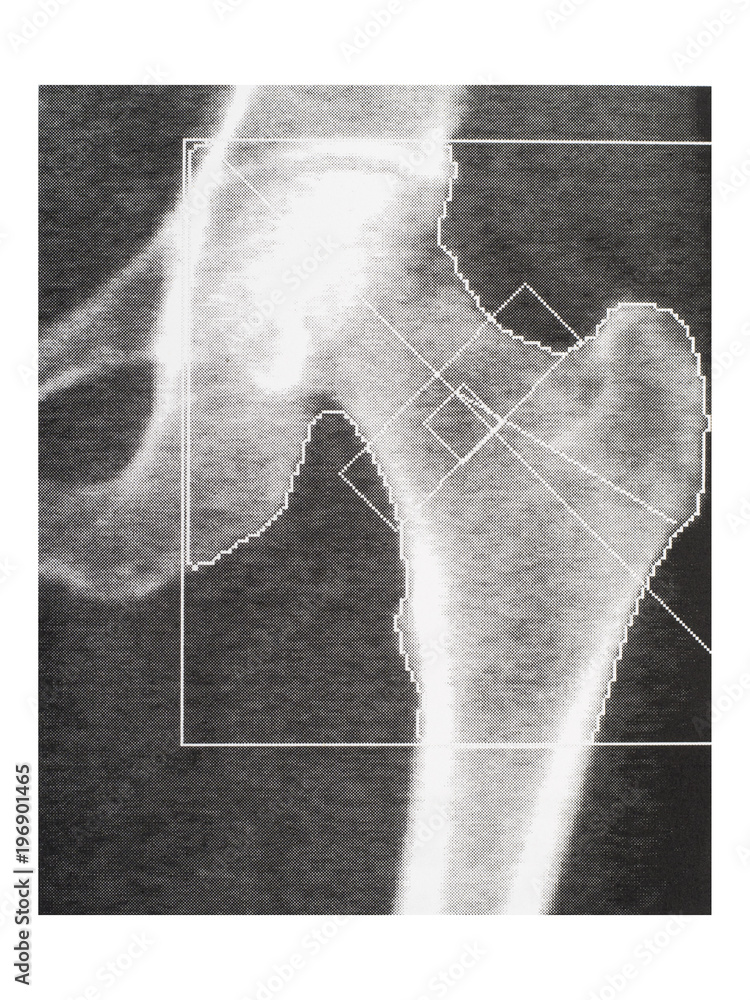Bone density medical scan - hip. Osteoporosis diagnosis. Stock Photo ...
