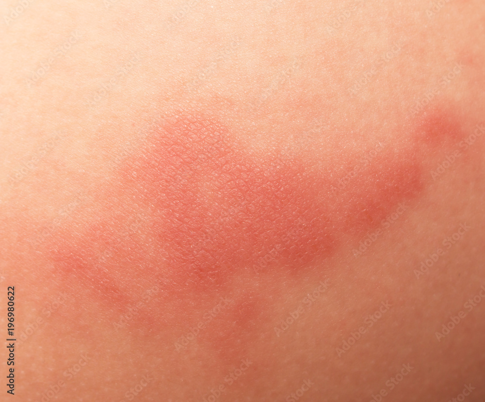 redness on baby skin Stock Photo | Adobe Stock