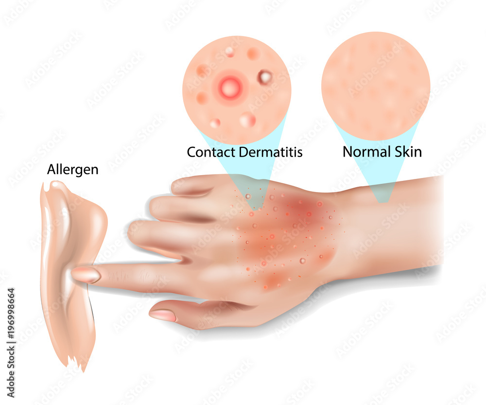 Skin Contact Dermatitis, Allergic contact dermatitis, Irritant contact ...