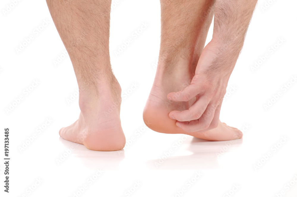 Man scratch the itch with hand. Infection of the feet caused by fungus ...