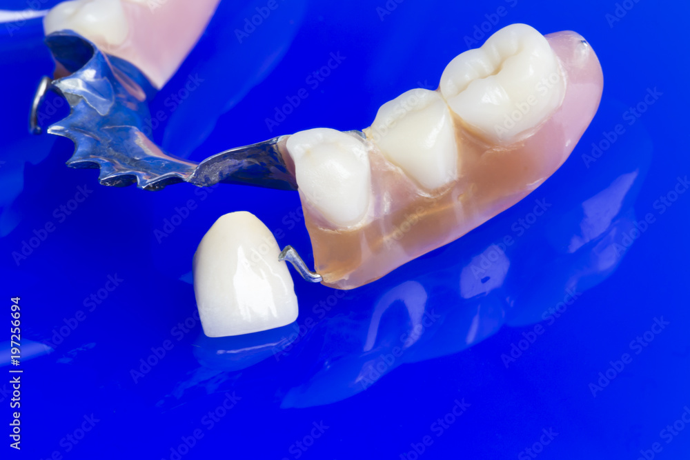 Lateral view of upper removable partial denture and lost tooth on blue ...