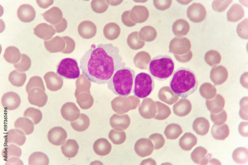Leukemia cells in blood smear, analyze by microscope Stock Photo ...