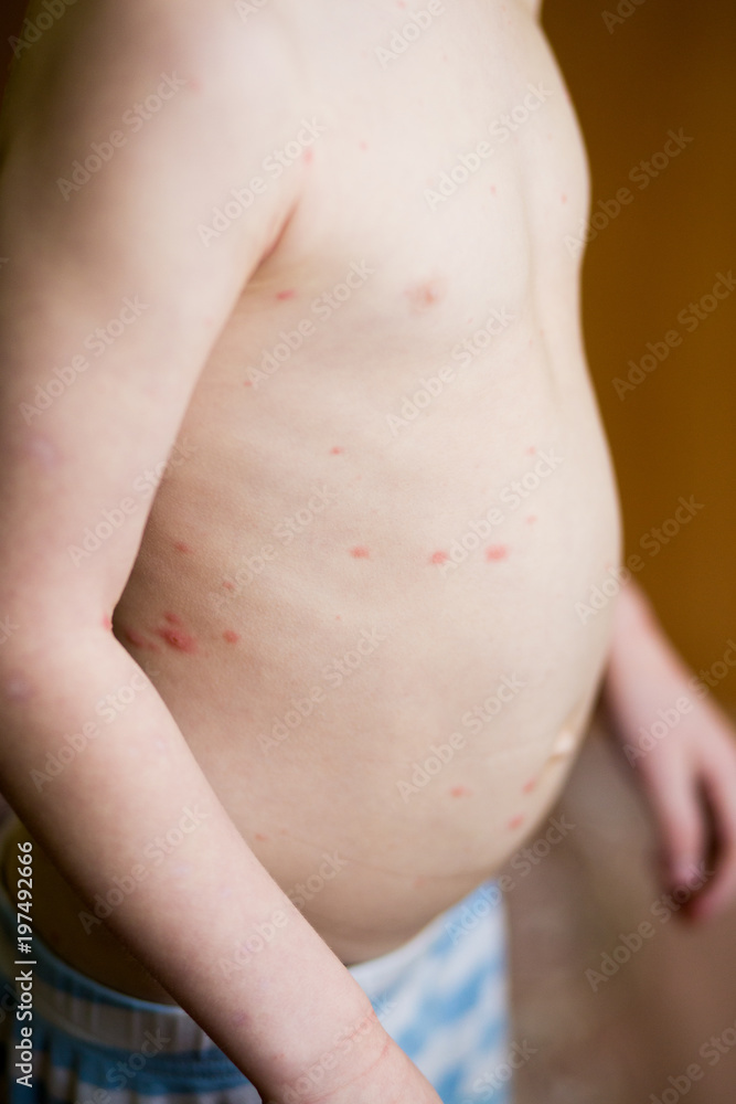 Baby with chicken pox rash. Varicella virus or Chickenpox bubble rash ...