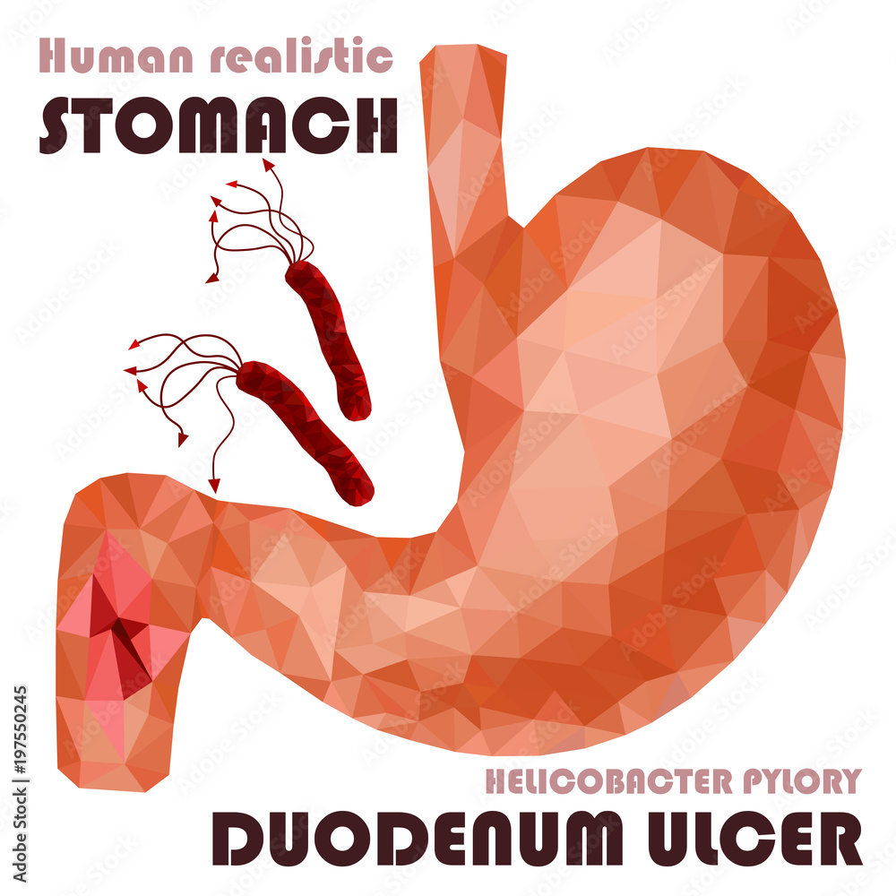Realistic low poly human stomach and inflammation of the duodenum ...