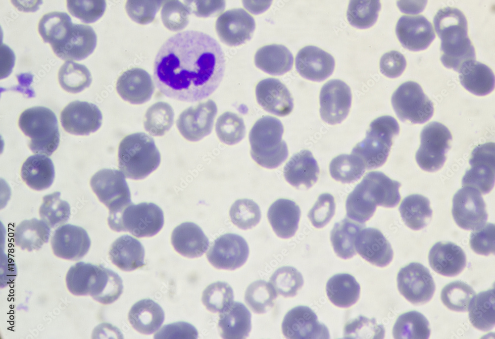 .Blood under a microscope. Lymphocyte Stock Photo | Adobe Stock