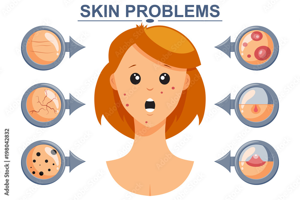 Skin problems vector infographics. Cartoon illustration of a woman face ...
