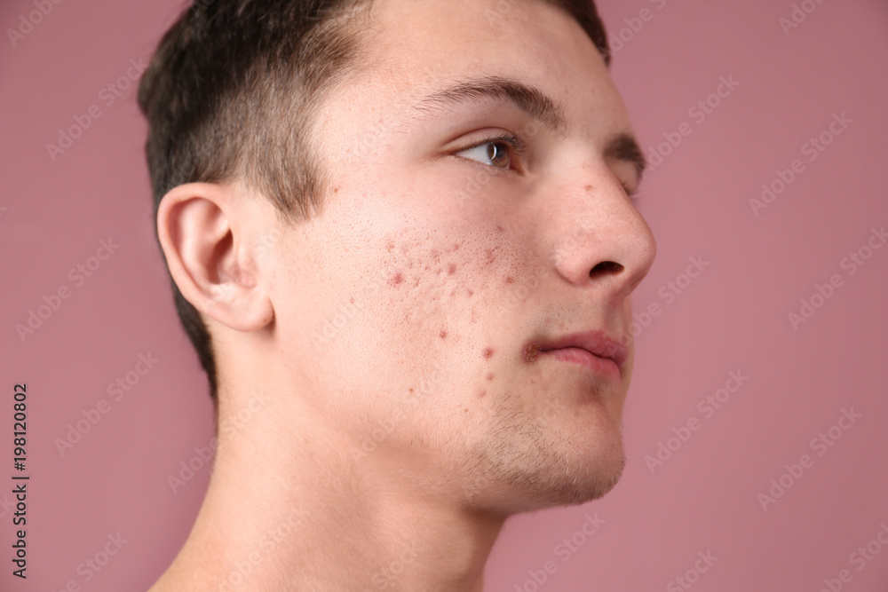 Young man with acne problem on color background Stock Photo | Adobe Stock