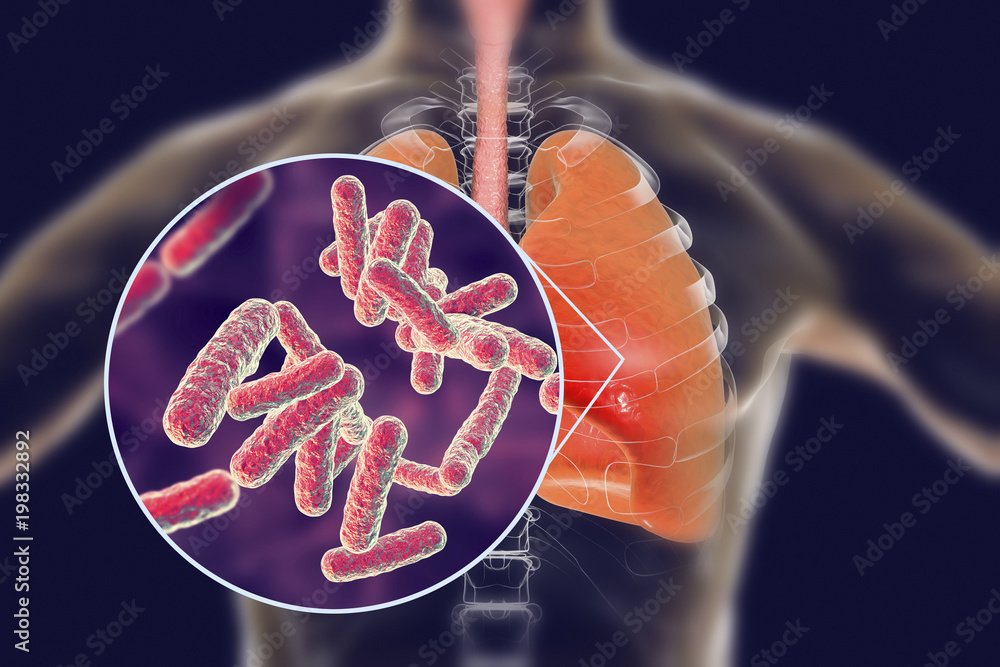 Bacteria pneumonia, medical concept Stock Illustration | Adobe Stock