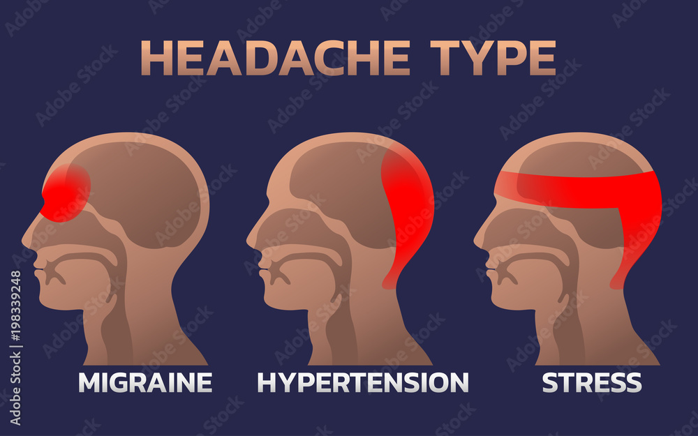 Types of Headaches Infographics design template, icon vector ...