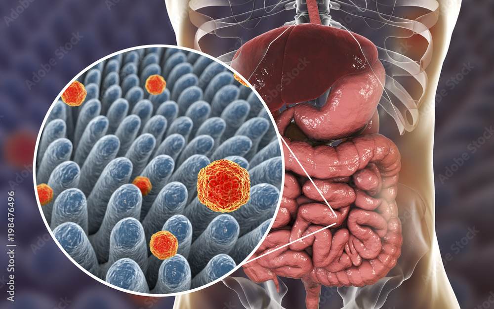 Hepatitis A viruses in small intestine Stock Illustration | Adobe Stock