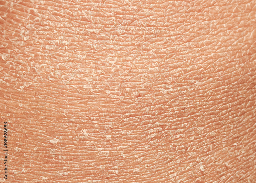 texture of the epidermis of human skin with flakes and cracked ...