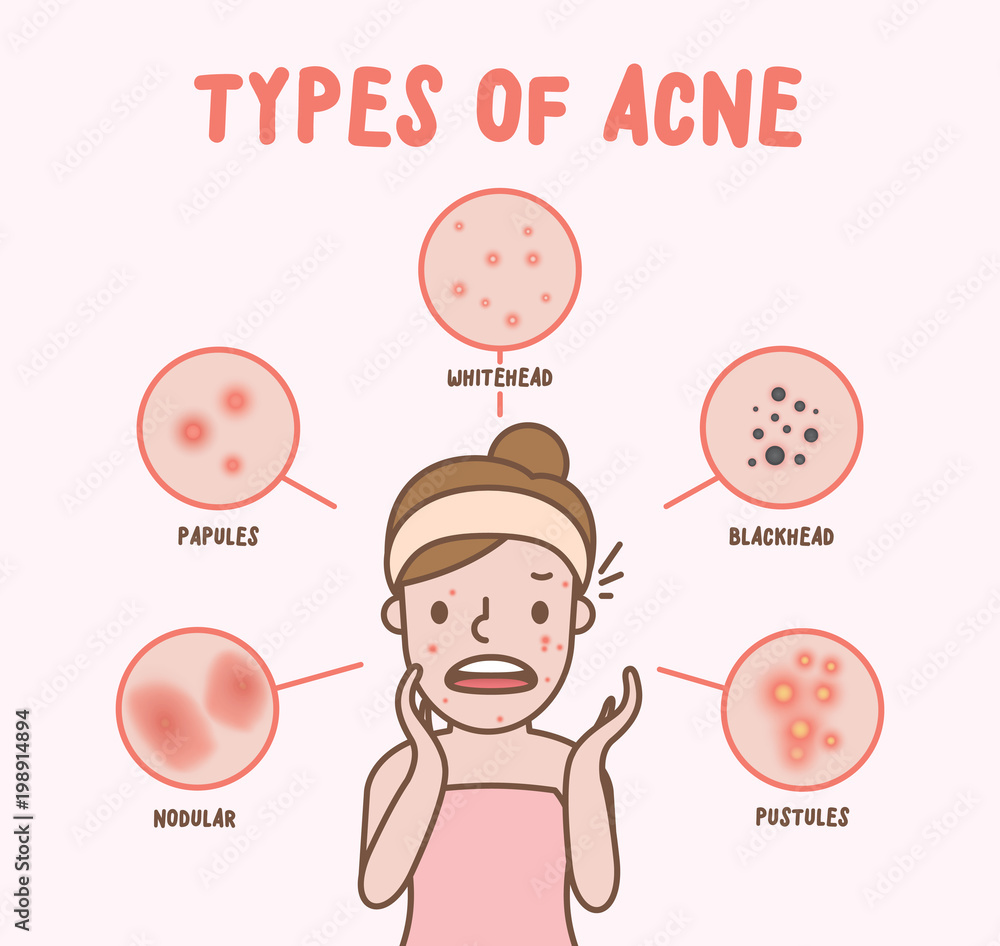 Types of acne with woman cartoon illustration vector on pink background ...