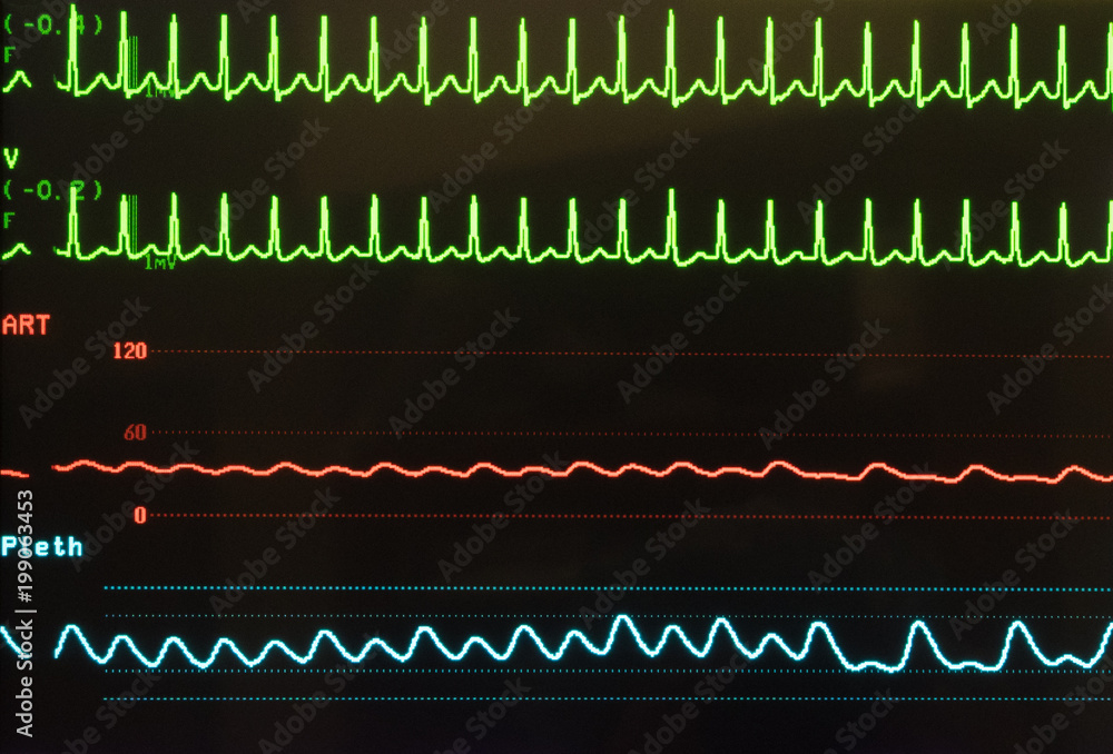 Supraventricular Tachycardia on Monitor in Green, arterial blood ...